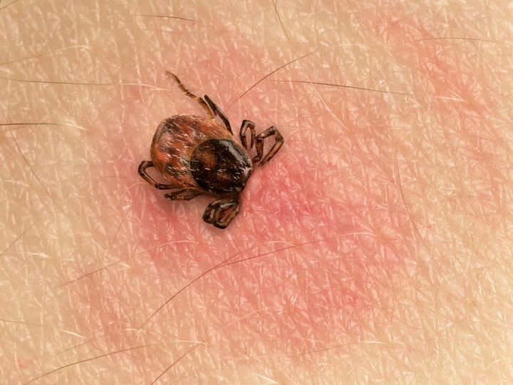 Zeckenbiss: Symptome, Behandlungen, Bilder und Prävention | Medisiegel.de